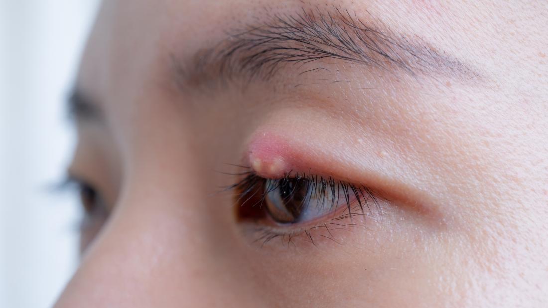 How Warm Compress Can Help Treat An Eye Stye Dr D Orio Eyecare How Warm Compress Can Help Treat An Eye Stye Dr D Orio Eyecare